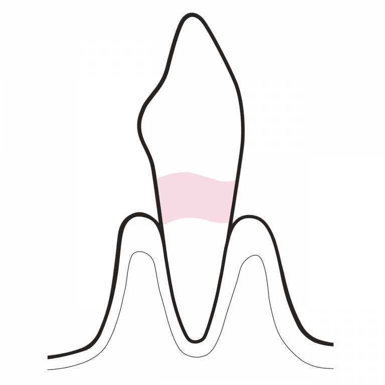 Guided Biofilm Therapy | AIRFLOW® Dental Spa